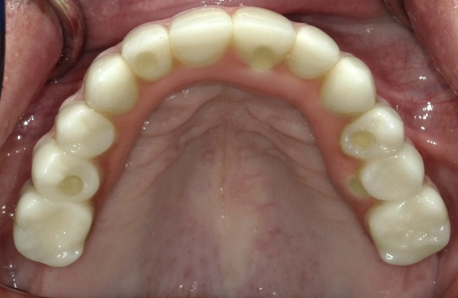 Full Arch Dental Implants East Brunswick NJ | Middlesex Periodontics